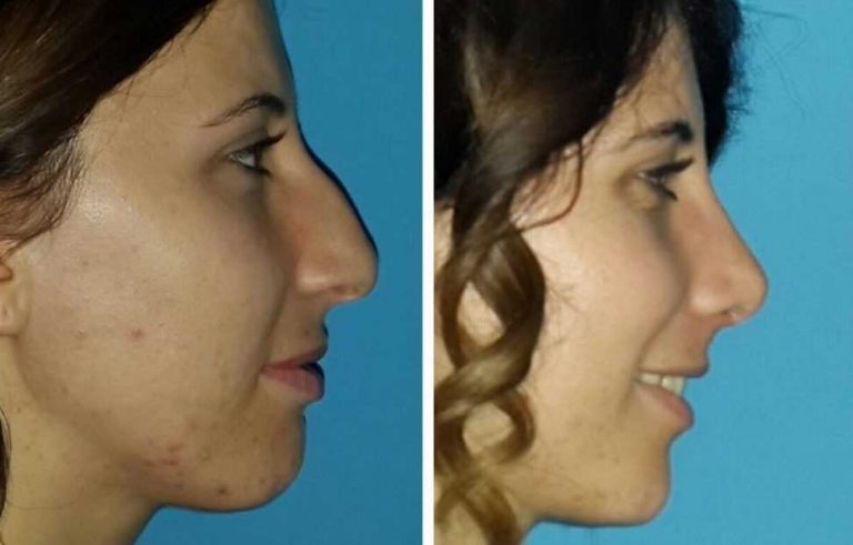 Nose Job - Nose Correction Surgery Up To 75% OFF in Turkey | MedAway