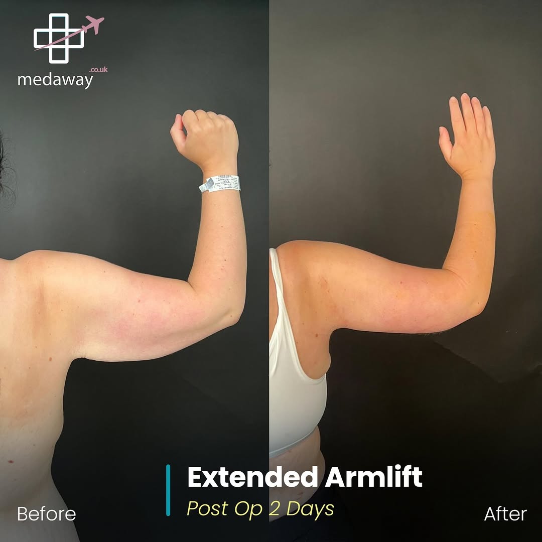 Arm Lift Before and After - Up to 15% OFF Packages | MedAway